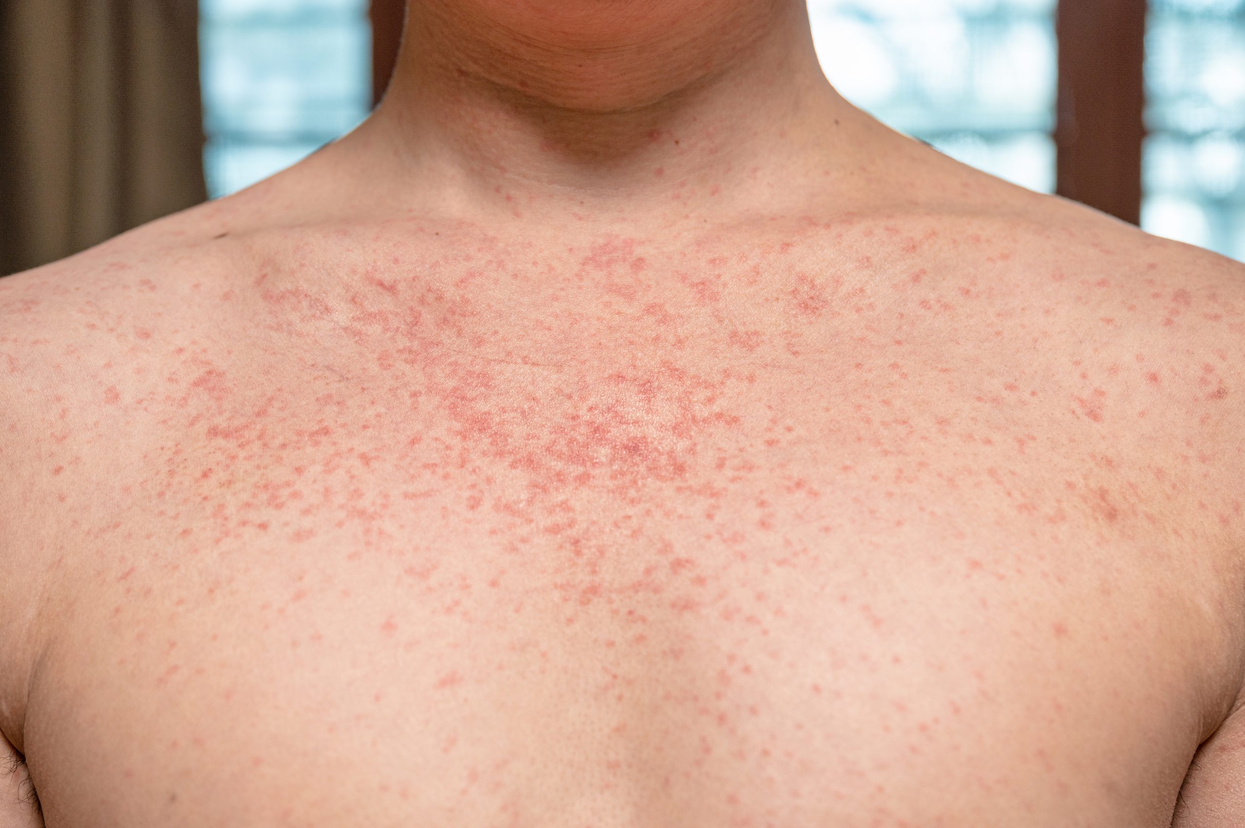 Health Officials Caution Fliers of Measles Exposure at LAX - MyNewsLA.com